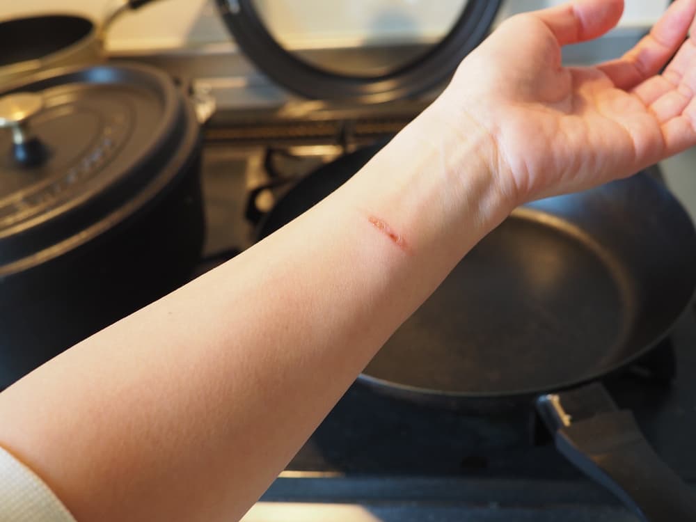 Indianapolis Attorneys for Burn Injuries from Cooking Accidents